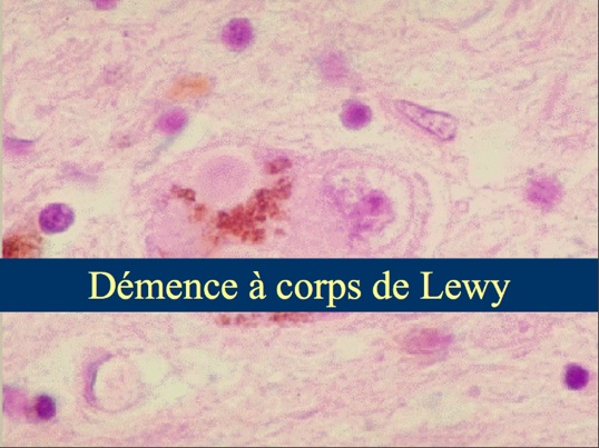 Maladie à corps de Lewy; demence a corps de lewy; demence senile de type corps de lewy